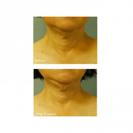 NECK & DECOLLETE CARE PERRICONE MD COLD PLASMA PLUS+ NECK & CHEST SPF25